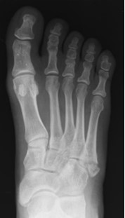 Fraturas do 5° metatarsal - Dr. Rafael Barban