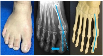 halux-valgo - Dr. Rafael Barban